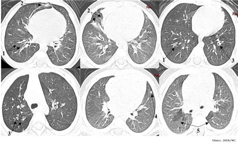 High Resolution Computed Tomography Findings In Young Infants With