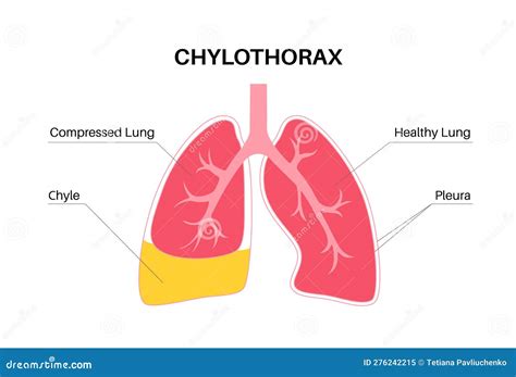 Chylothorax Lung Diseases Healthcare Medical Infographic Banner Illustration Cartoondealer