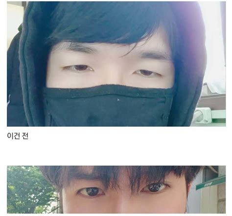 블라인드 블라블라 남자 눈 수술 이정도면 대박아니야
