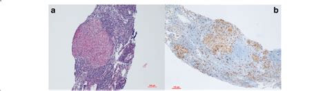 Lymphonode Biopsy Revealed The Presence Of Small Non Caseating
