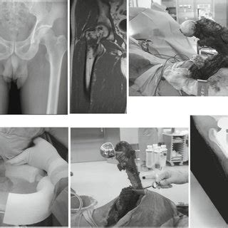 Case An Year Old Man With An Osteosarcoma Arrows Of The Left Download Scientific