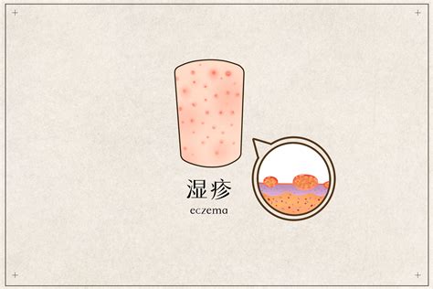 什么是特应性皮炎？