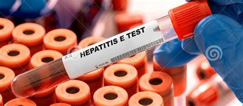 Hepatitis E Outbreak In Wau Radio Tamazuj