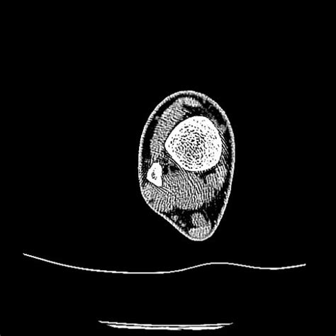 Tibia Recurvatum Lower Extremity Cts