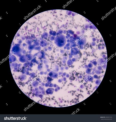 Malignant Cells Multiple Nuclei Prominent Nucleolimesothelial Stock