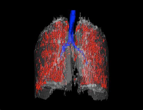 Dominik Hartl Md On Linkedin Autologous Transplantation Of P63 Lung