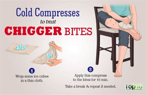 How To Treat Chigger Bites Top 10 Home Remedies