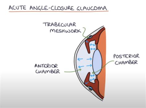 Acute Angle Closure Glaucoma Flashcards Quizlet