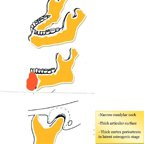 Pdf Diagnosis And Management Of Mandibular Condyle Fractures