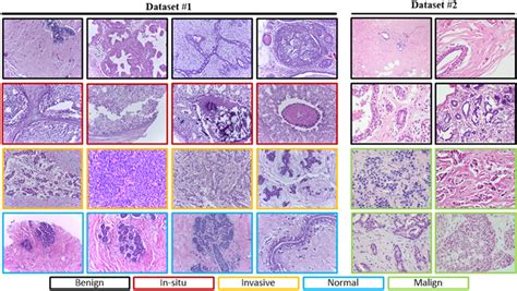 examples of breast cancer histological images in dataset 1 and dataset