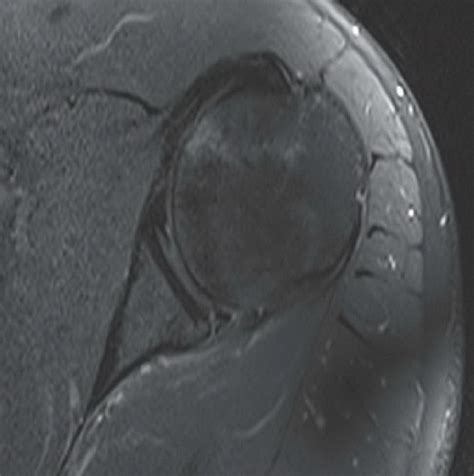 Posterior Shoulder Dislocation Radiology Key