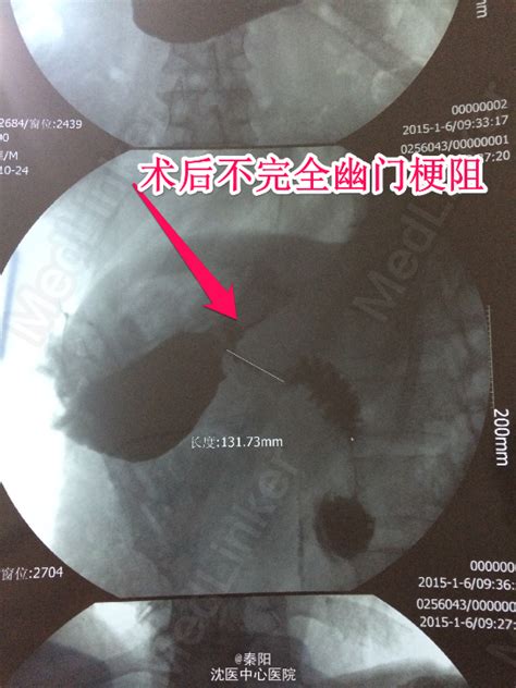 十二指肠球部溃疡穿孔休克术后肠瘘的处理 医联