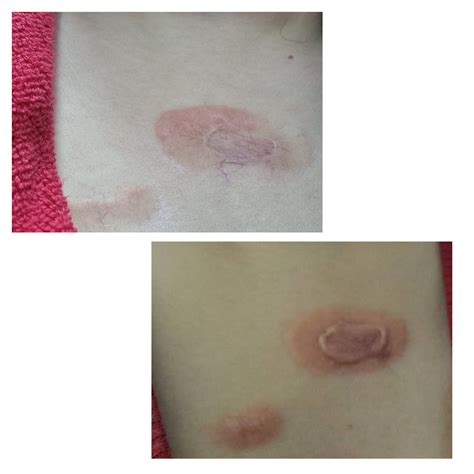 Keloid 35 Month Eclar Plaster Update In Comments Rkeloids