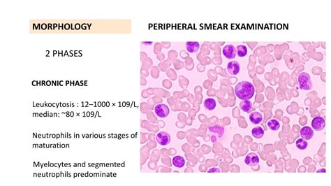Chronic Myeloid Leukemia Cml Pathogenesis Diagnosis And Treatment Pathology Made Simple