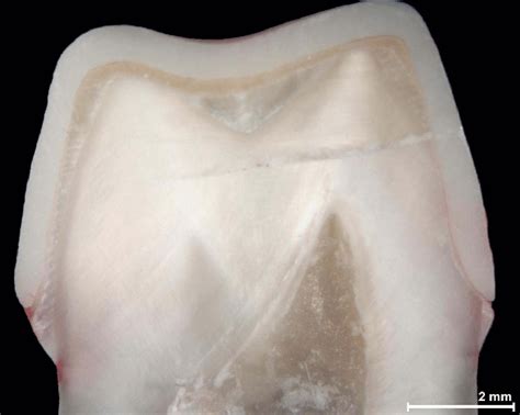Representative Microphotograph Of Microleakage Detection With 2 Download Scientific Diagram
