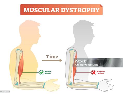 근 위축 증에 대 한 벡터 일러스트입니다 정상적인 근육과 위축된 근육 비교 의료 제도 어떻게 시간 건강을건강 하 고 약한 인간을 영향을 줍니다 근육에 대한 스톡 벡터 아트