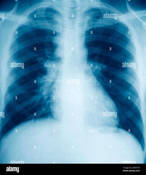 Lung Adenopathy Coloured Frontal Chest X Ray Of The Lungs Of A Patient