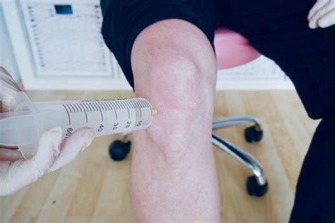 How To Do Subcutaneous Ozone Knee Injections The Power Of Ozone
