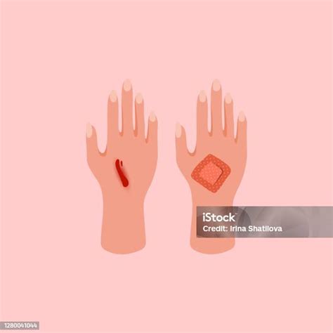 부러진 잘라 부상 손 타박상 외상 또는 상처에 대한 응급 처치 의료 접착제 석고 0명에 대한 스톡 벡터 아트 및 기타 이미지 0명 X 레이 건강관리와 의술 Istock