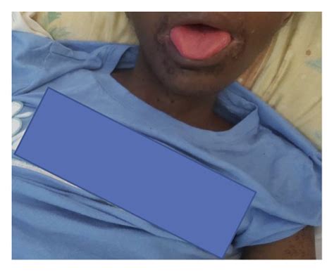 Dermatological Manifestations On Admission Showing A Hair