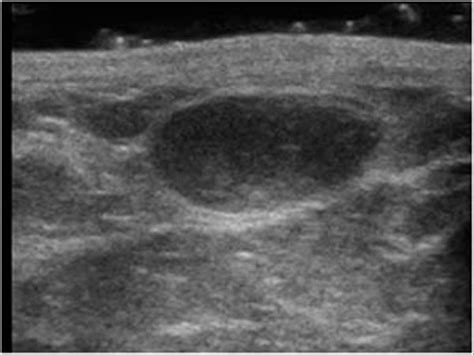 Fat Necrosis Breast Ultrasound