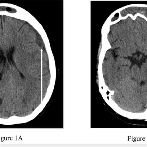 A Loculated Extra Axial Collection Overlying The Left Frontotemporal