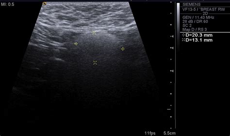 The Ruptured Pip Breast Implant Clinical Radiology