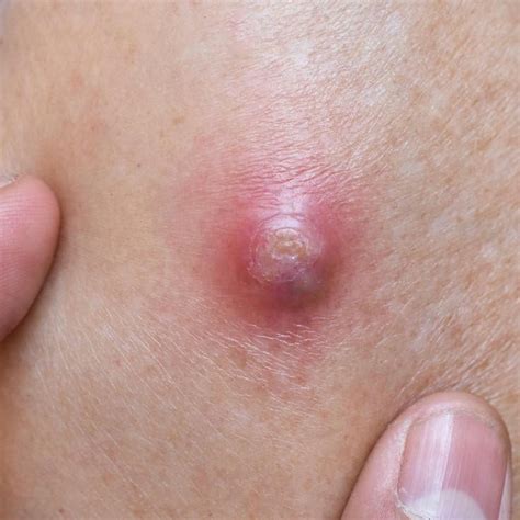 Homeopathic Treatment For Boils Furuncles Philadelphia Pa Patch
