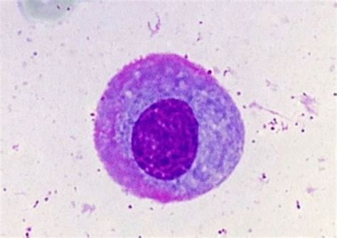 Iga Multiple Myeloma
