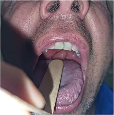 Closer Inspection Of Uvula On Oral Examination Download Scientific