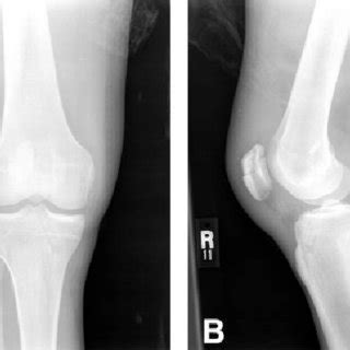 A Computed Tomography Scan And B Anteroposterior And C Lateral