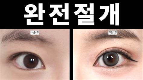 완전 절개 쌍꺼풀 수술 장점 단점 흉터까지 총정리 쌍수 전 이 영상 필수 Youtube