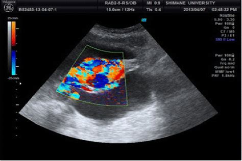 Figure 14 From Ultrasound Elastography Time Delay Estimation Semantic Scholar