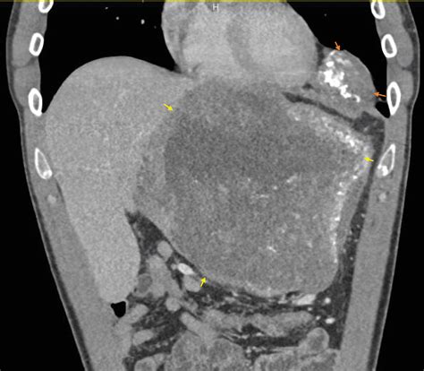 Figure 1 From Rare Case Of Multifocal Alveolar Echinococcosis Semantic Scholar