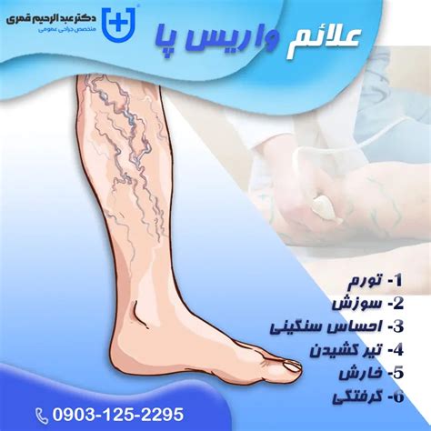 واریس پا در زنان علت و علائم تا درمان 100 واریس در زنان
