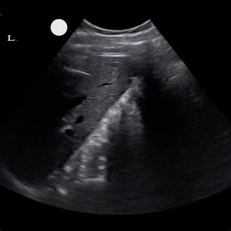 [video] Daniel Ben Mordechay On Linkedin Ultrasound Hepatic Hemangioma Liver