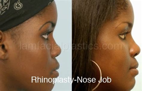 Rhinoplasty Procedures Dallas Tx Lam Facial Plastics