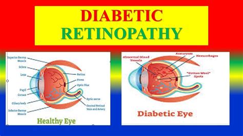 Diabetic Retinopathy Define Causes Pathophysiology Clinical