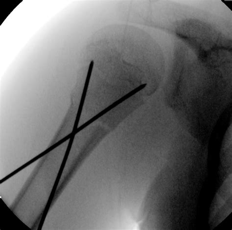 Proximal Humerus Metaphyseal Fracture