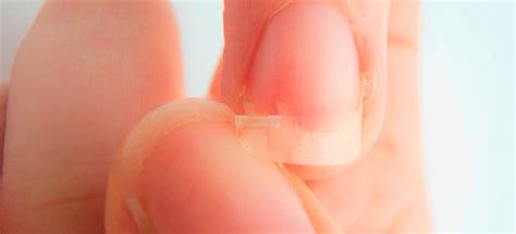 Uñas débiles y quebradizas causas y tratamiento