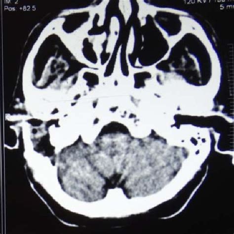 Computerised Tomography Of Brain Showing With Soft Tissue Density Download Scientific Diagram
