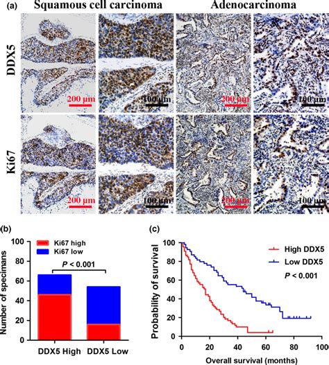 DDX5 Promotes Proliferation And Tumorigenesis Of Nonsmallcell Lung