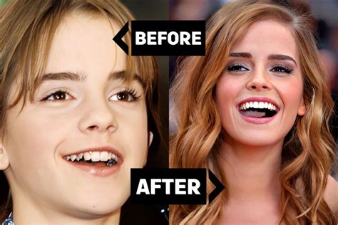 Emma Watson S Magical Smile Makeover Treatment Antalya Dent Smile
