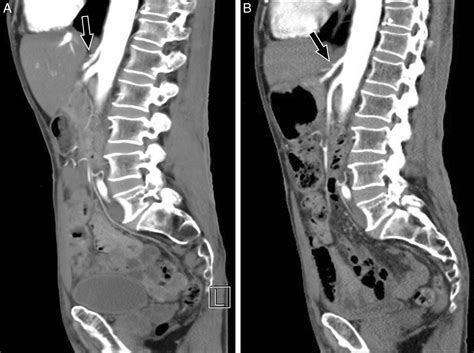 Median Arcuate Ligament Syndrome In An Old Male A Case Repo