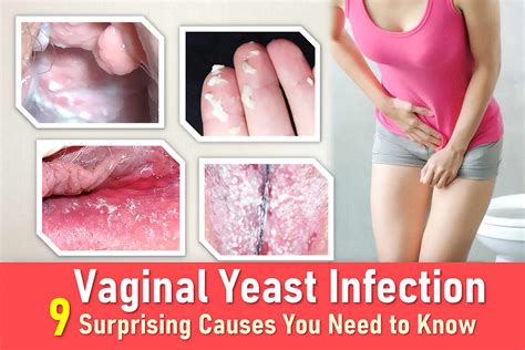 Vaginal Yeast Infection 9 Surprising Causes You Need To Know