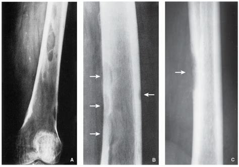 Osseous Metastases Radiology Key