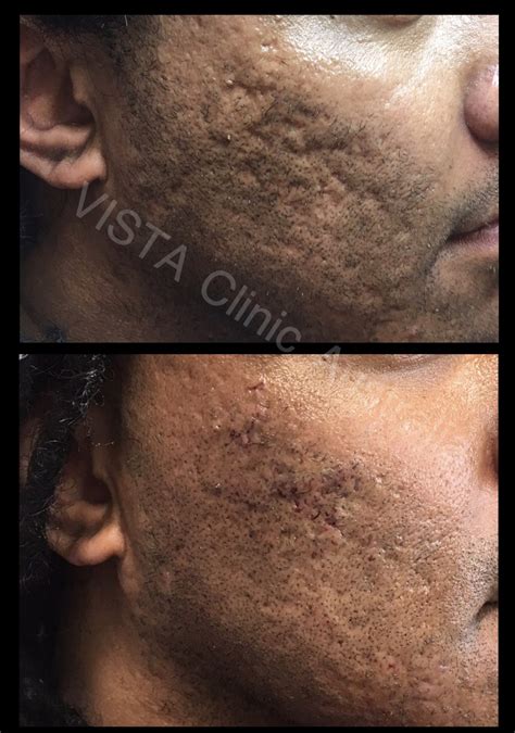 Subcision Vista Clinic Melbourne Australia