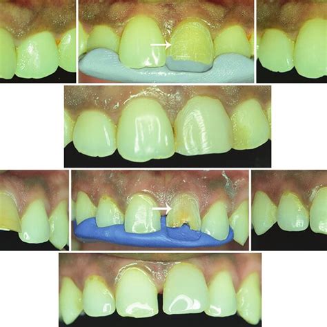 A I Fractured Tooth Structure Loss 50 And Download Scientific