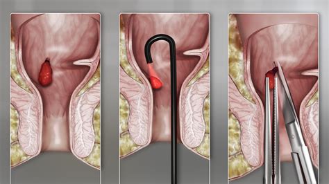 Internal Vs External Hemorrhoids