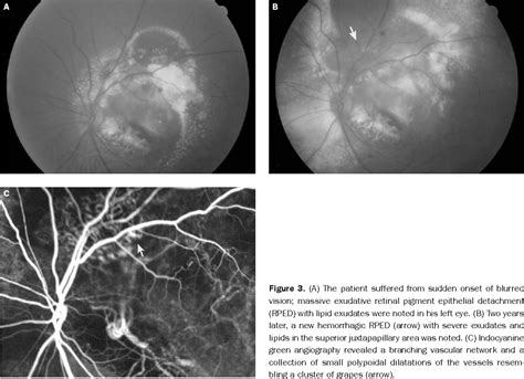 Figure 3 From Idiopathic Polypoidal Choroidal Vasculopathy Semantic